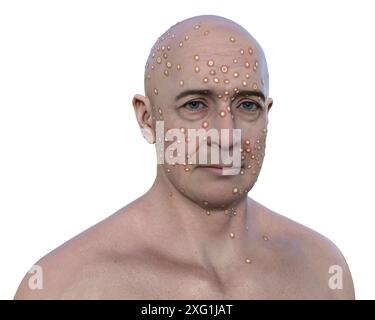 Illustration of a man with a rash caused by infection with a pox virus ...