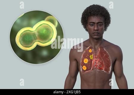 Illustration of pulmonary blastomycosis, and a close-up of the ...