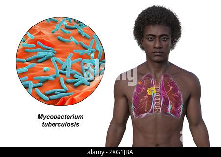 Illustration of a man's thoracic (chest) cavity revealing a Ranke ...