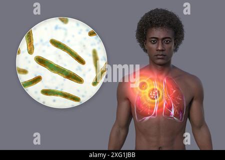 Illustration of a man's thoracic (chest) cavity revealing a Ranke ...