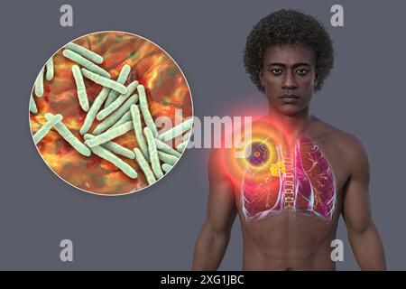 Illustration of a man's thoracic (chest) cavity revealing a Ghon ...