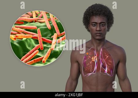 Illustration of a man's thoracic (chest) cavity revealing a Ghon ...
