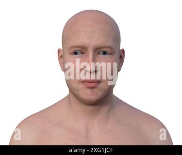 Illustration of a man with exotropia showing outward eye misalignment ...