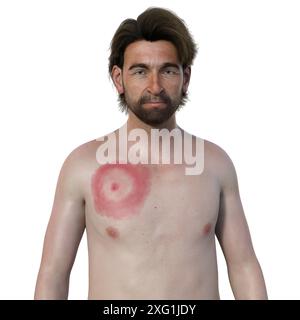 Illustration showing erythema migrans, a characteristic rash seen in ...