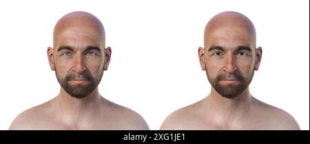 Illustration of a man with miosis (constricted eye pupils Stock Photo ...