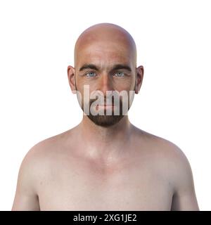 Illustration of a man with constricted eye pupils, known as miosis ...