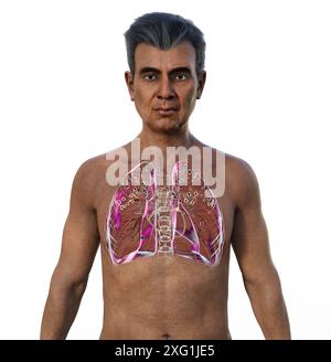 Illustration of a man with lungs affected by silicosis, showing dark ...