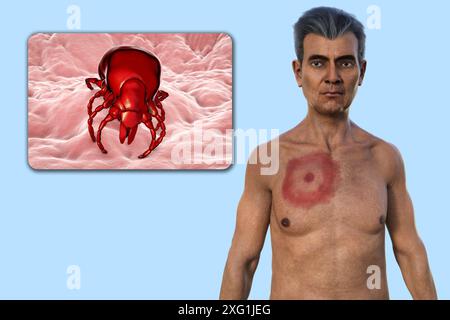 Illustration showing erythema migrans, a characteristic rash seen in ...
