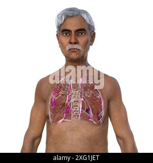 Illustration of a man with lungs affected by silicosis, a respiratory ...