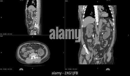 CT scan from the front of the abdomen of a patient with cholelithiasis ...