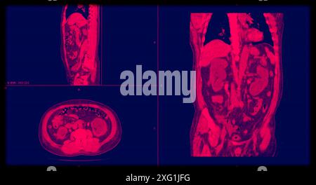 Kidneys, CT scan. Coloured 3-D computed tomography (CT) scan of kidneys ...