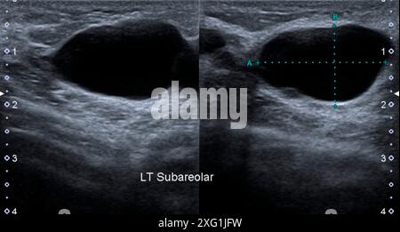 Ultrasound scan of a normal eye. Two views of the same eye are shown ...