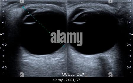 Ultrasound scan of a normal eye. Two views of the same eye are shown ...