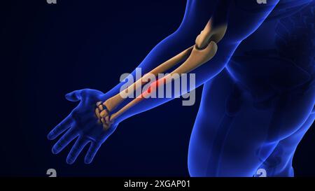 Broken Ulna Bone medical concept Stock Photo - Alamy