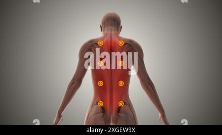 Myofascial pain syndrome or chronic pain disorder Stock Photo - Alamy