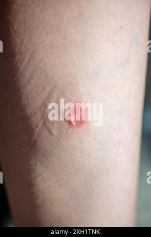 A bright bite from an insect on a person's leg, lubricated with a ...