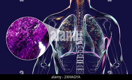 Illustration depicting lungs affected by silicosis, revealing dark ...
