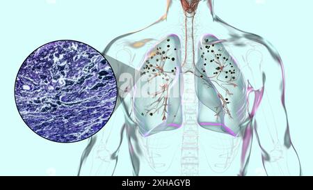 Illustration depicting lungs affected by silicosis within a transparent ...