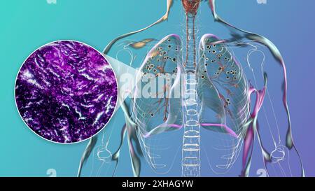 Illustration depicting lungs affected by silicosis, revealing dark ...