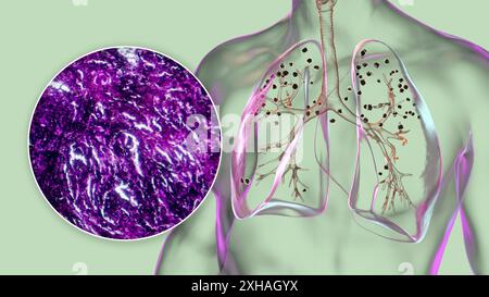 Illustration depicting lungs affected by silicosis within a transparent ...