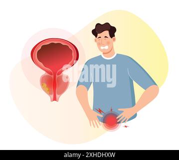 Medical illustration of benign prostatic hyperplasia, enlarged prostate ...