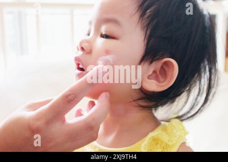 mother applying antiallergic medicine cream at cute asian girl face ...