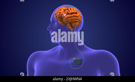 Deep brain stimulation medical concept Stock Photo - Alamy