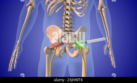 Injecting steroids to treat Piriformis Syndrome Stock Photo - Alamy
