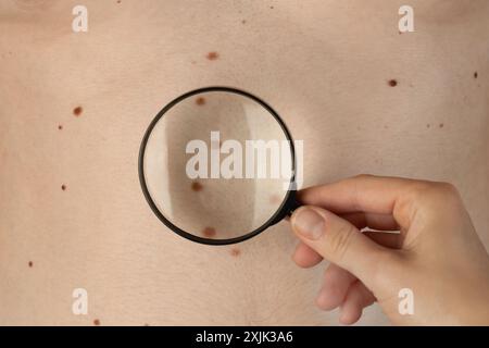Dermatologist examining patient's birthmarks with magnifying glass ...