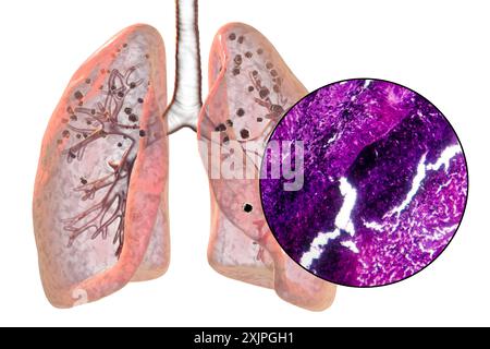 Illustration of lungs affected by silicosis, revealing dark silicotic ...