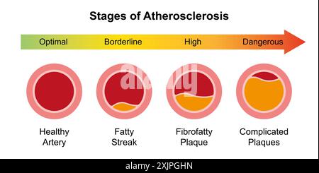 Atherosclerosis stages, illustration Stock Photo - Alamy