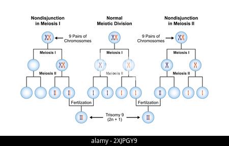 Trisomy 9 syndrome, illustration Stock Photo - Alamy