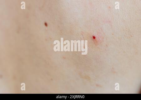 tick bite wound on back, medical plaster on skin back, anti ...