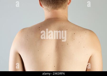Man with birthmarks on his skin against grey background, closeup Stock ...