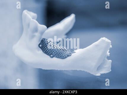 Prototype of lower human jaw with medical titanium implant from ...