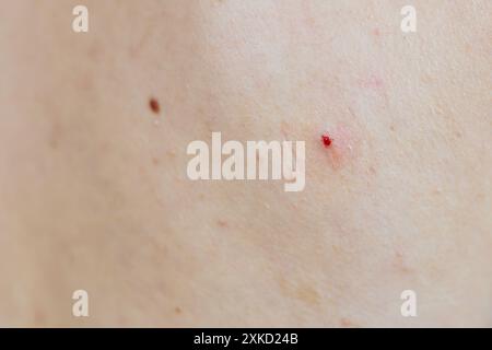 tick bite wound on back, medical plaster on skin back, anti ...