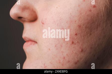 Pimple on face. Skin texture. Closeup acne skin. Treatment for skin ...