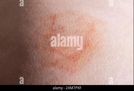 Bruise and subcutaneous lump on the patient s skin after injections ...