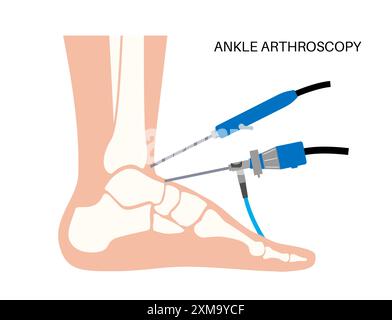 Illustration of an ankle arthroscopy procedure. This is a procedure for ...