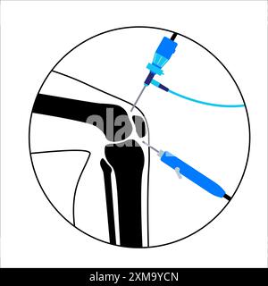 Knee joint arthroscopy, illustration Stock Photo - Alamy