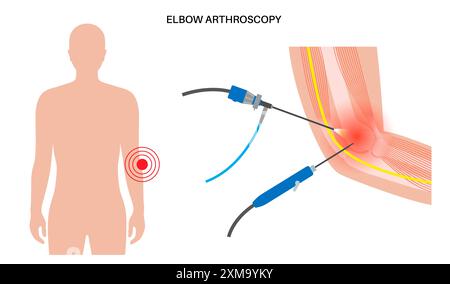 Illustration of elbow arthroscopy surgery. This is a procedure for ...