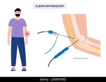Illustration of elbow arthroscopy surgery. This is a procedure for ...