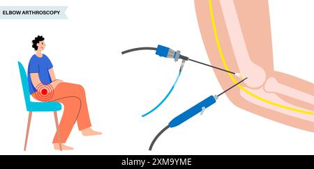 Illustration of elbow arthroscopy surgery. This is a procedure for ...