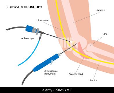 Illustration of elbow arthroscopy surgery. This is a procedure for ...