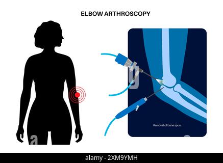 Illustration of elbow arthroscopy surgery. This is a procedure for ...