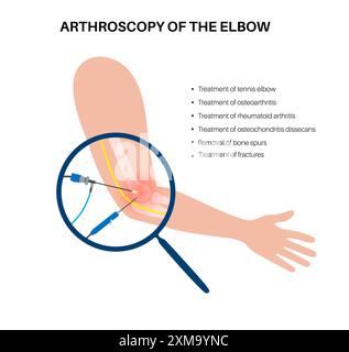 Illustration of elbow arthroscopy surgery. This is a procedure for ...
