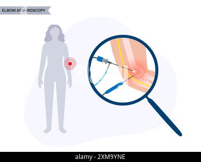 Illustration of elbow arthroscopy surgery. This is a procedure for ...