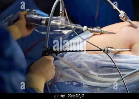 Obesity surgery. Weight loss surgery with laparoscopy technique Stock ...