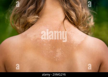 back view of little girl with sunburn Stock Photo - Alamy
