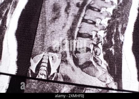 MRI of a patient with intervertebral disc protrusion and ...